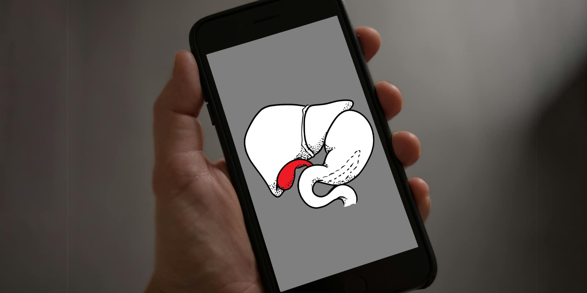 Download Our App for Your New Gallbladder | Points in Case